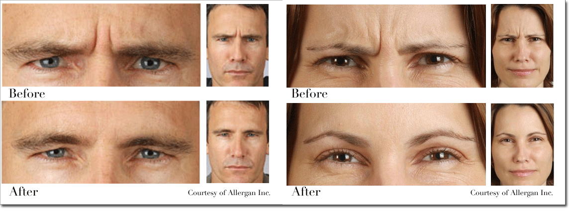 Botox Frequently Asked Questions - Oris Medical Botox Frequently Asked Questions - Oris Medical